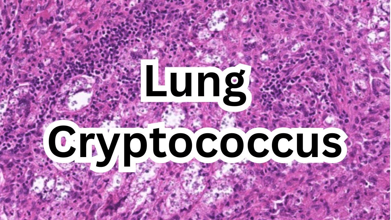 Cryptococcus in Lung - YouTube