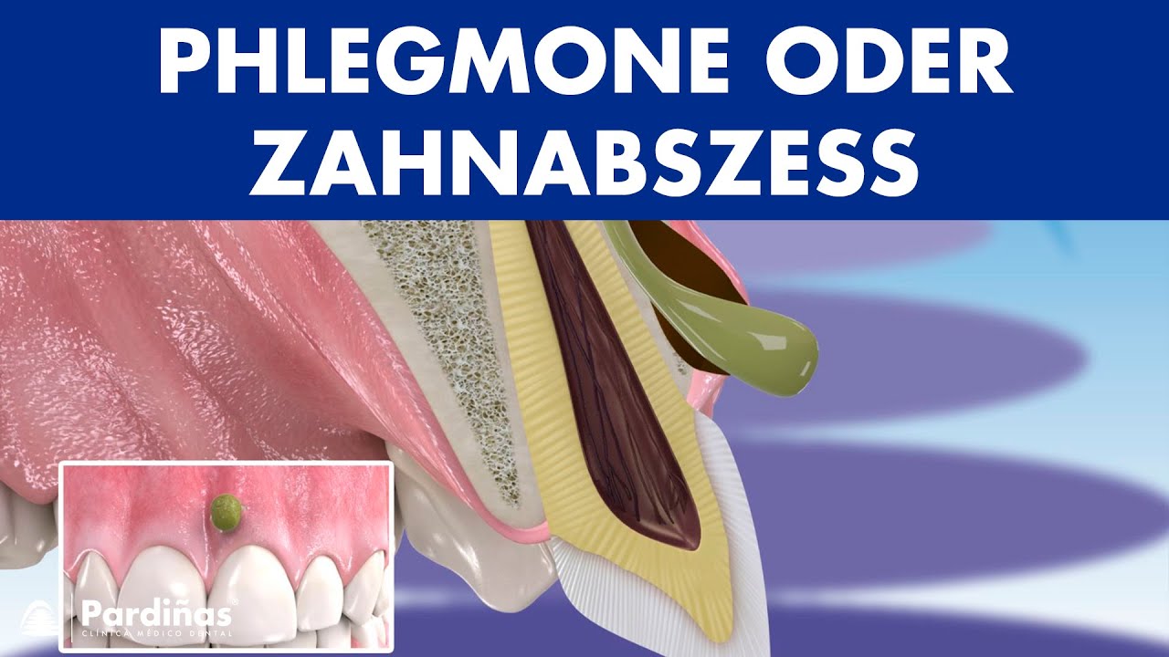PHLEGMONE - Symptome und Behandlung von ABSZESS Zahnfleisch © - YouTube