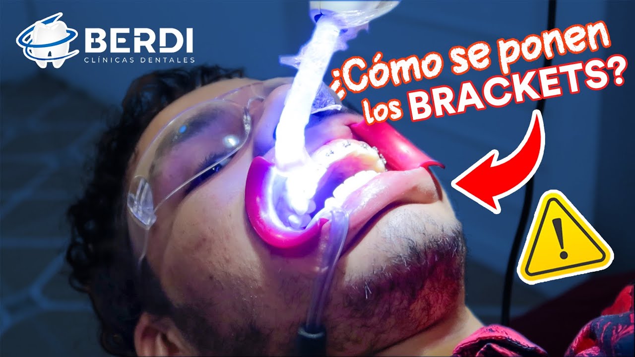 Así se ponen los brackets paso a paso | Salina Cruz, Oaxaca 🦷😬🌴 - YouTube