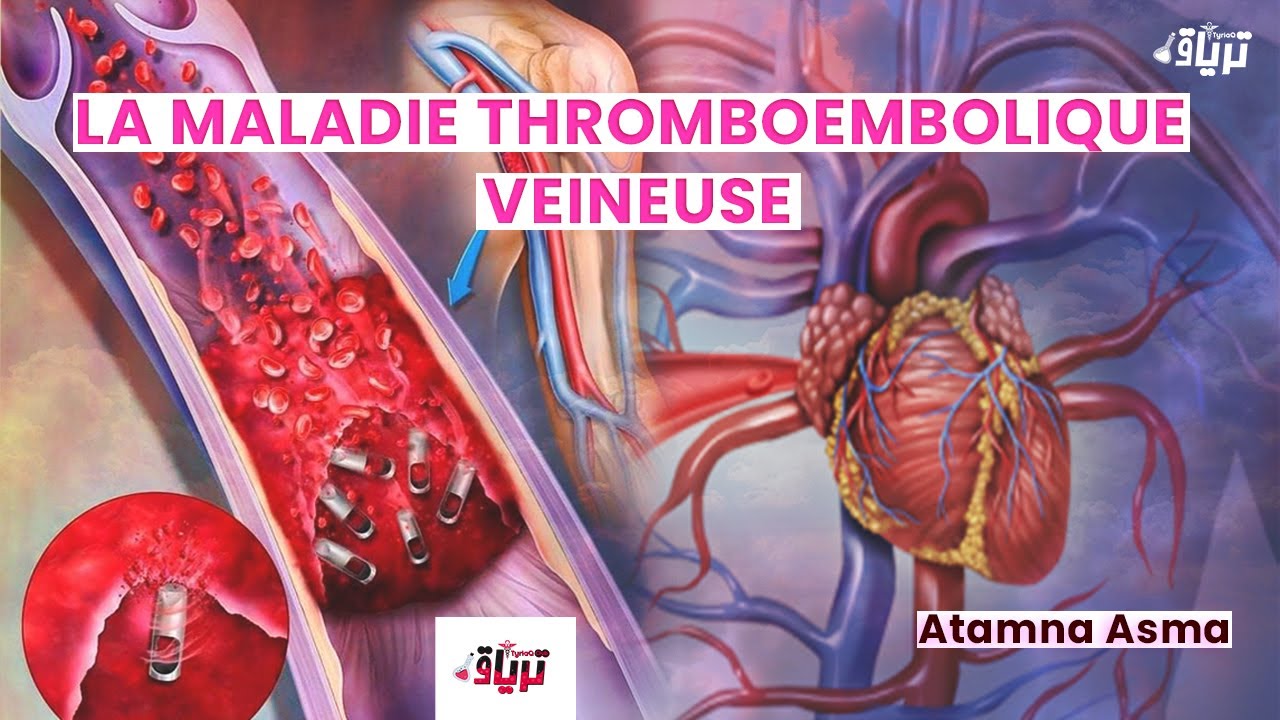 #Physiopathologie La maladie thromboembolique veineuse Par Asma Atamna ...