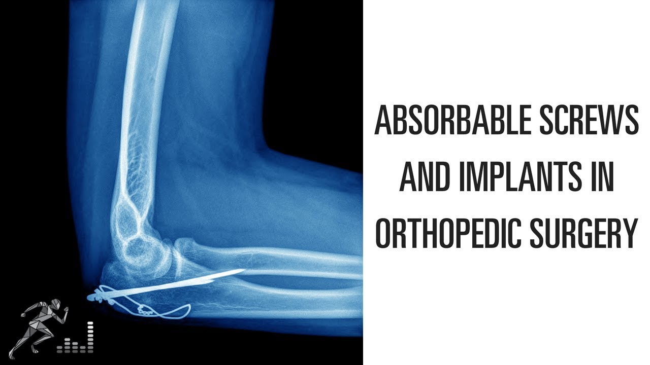 Absorbable screws and implants in orthopedic surgery - YouTube