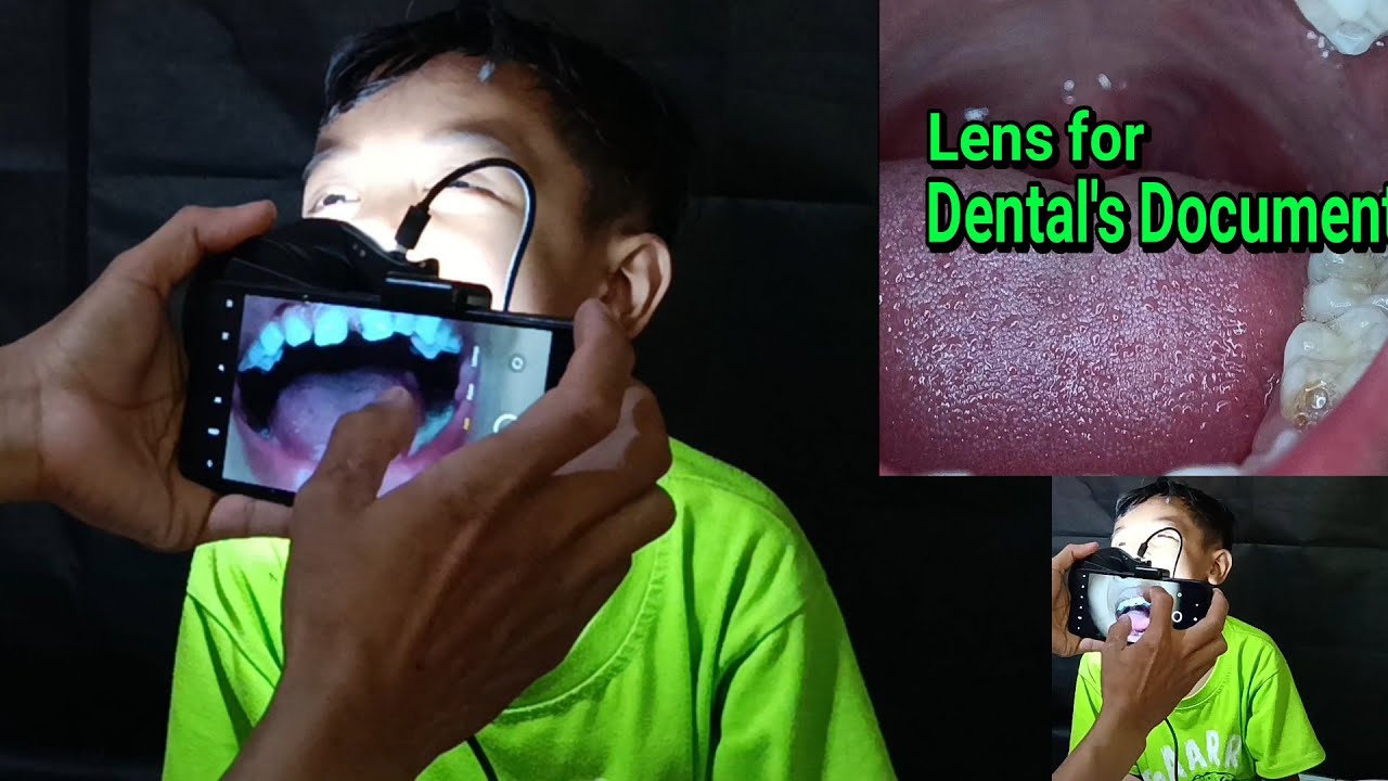 lenses for dentists to document tooth decay such as cavities, tartar ...