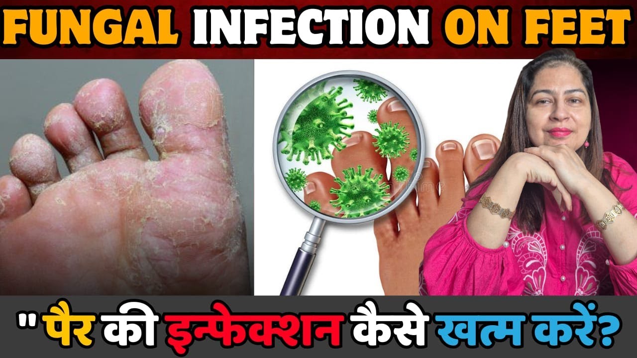 Fungal Infection of Feet | Tinea Pedis | Athlete’s Foot Symptoms And ...