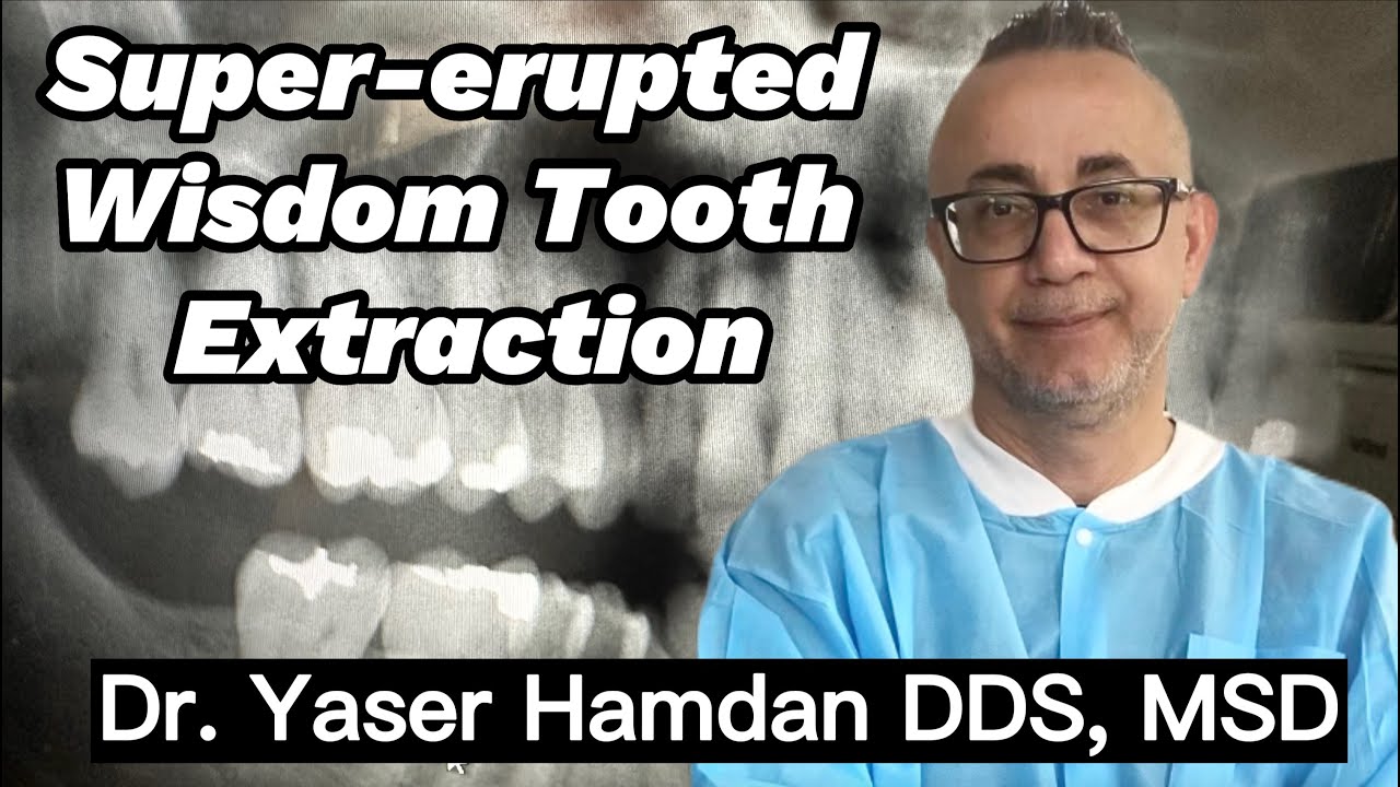 Super-erupted Wisdom Tooth Extraction #minimallyinvasive #wisdomteeth # ...