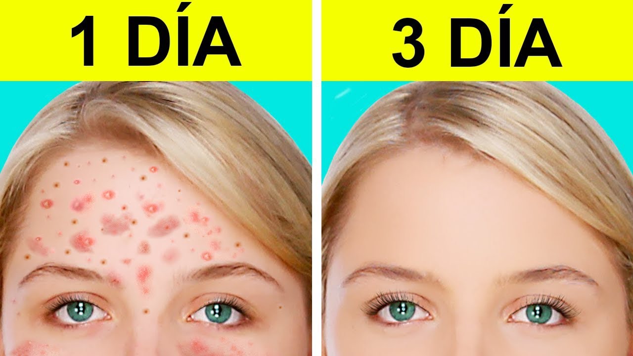 DESAPARECE LOS GRANITOS EN DÍAS CON UN SOLO INGREDIENTE, Trucos y Más ...