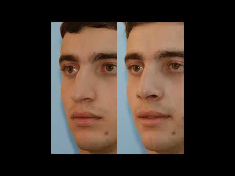 Burun emeliyyati Rinoplastika