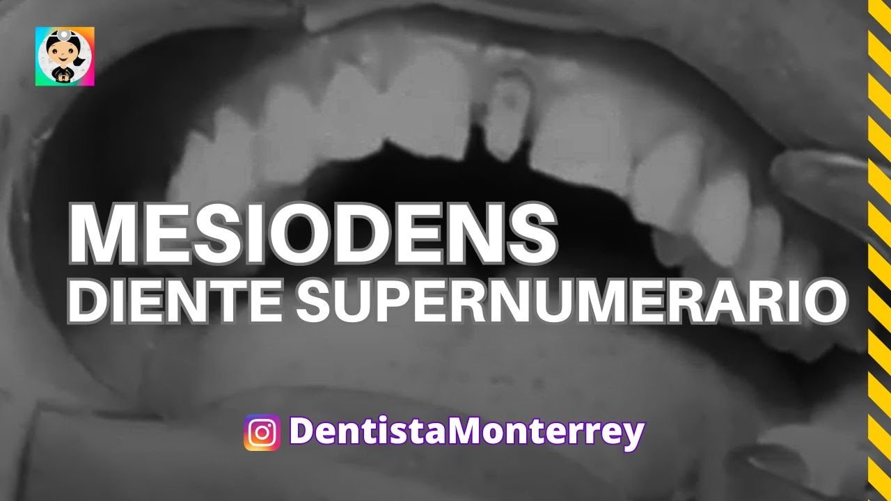 MESIODENS Diente SUPERNUMERARIO👅 Corona Dental #mesiodens #dentaltip ...