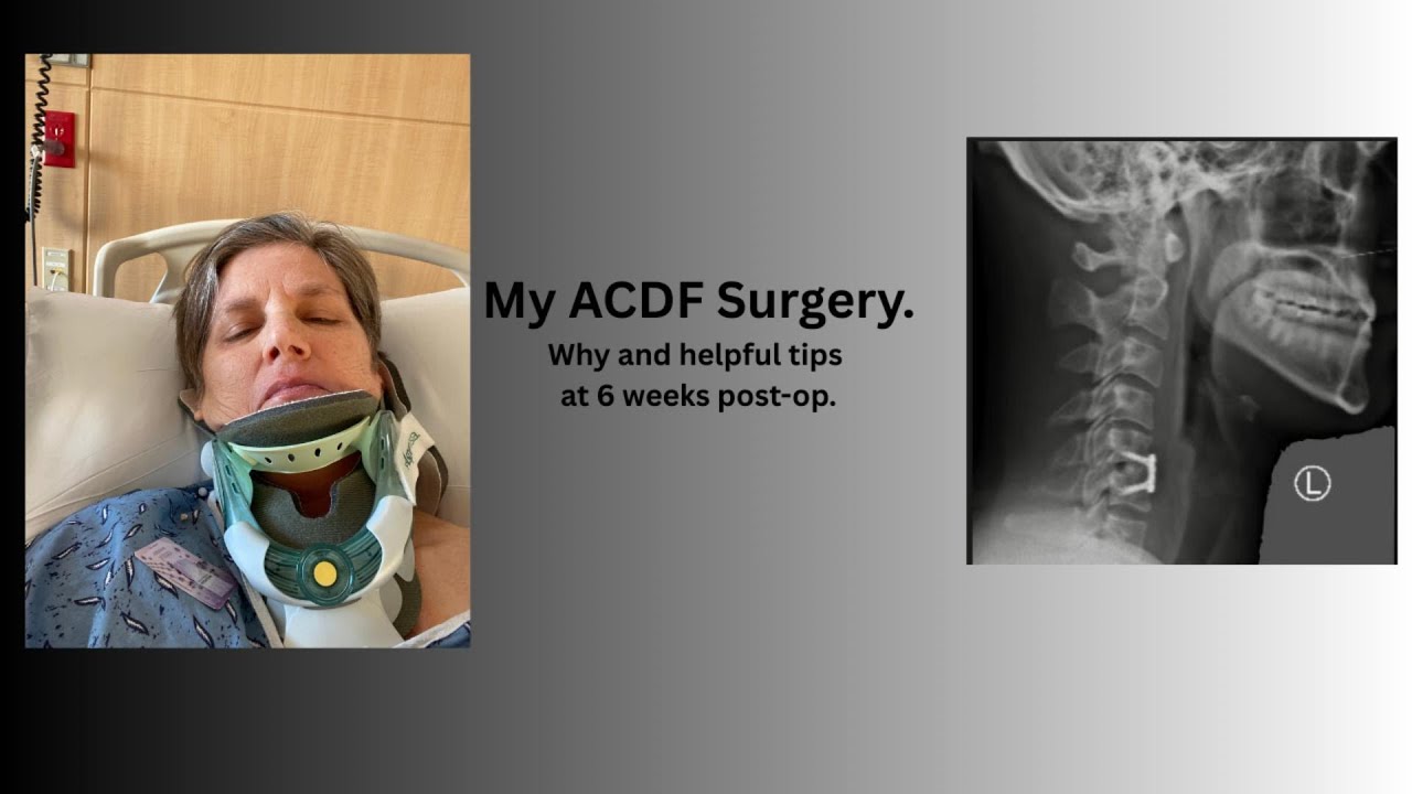 My ACDF Surgery. Why and helpful tips at 6 weeks post-op. - YouTube