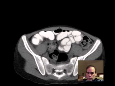 Colon Cancer & CT Anatomy 14yo DISCUSSION by Radiologist - YouTube