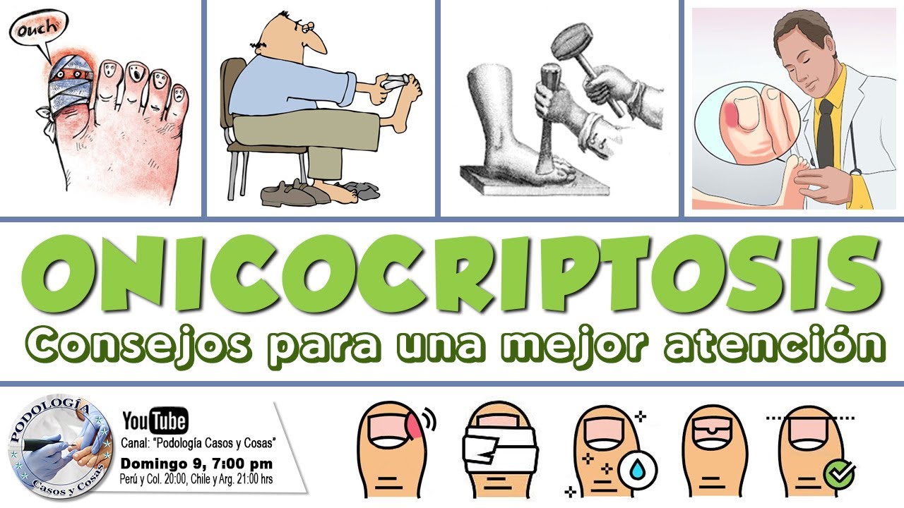 ONICOCRIPTOSIS: CONSEJOS PARA UNA MEJOR ATENCIÓN | Podología Casos y ...