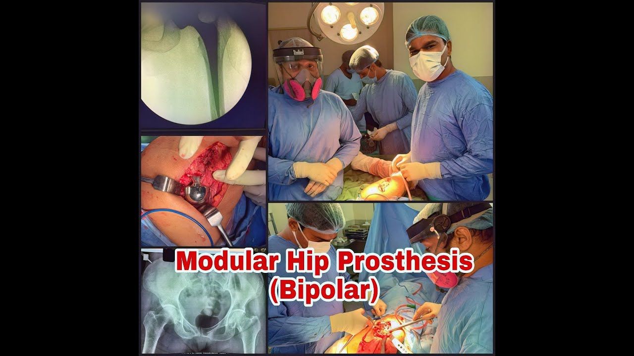 Modular Hip Prosthesis (Bipolar) DIPAK SURGICAL AMRAVATI - YouTube
