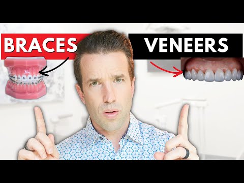Braces or Veneers?!