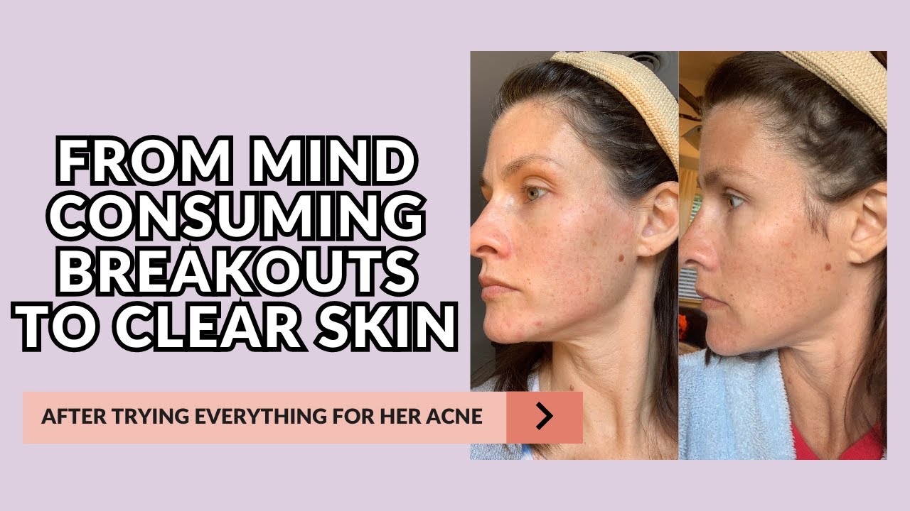 From Mind Consuming Breakouts To Clear Skin Katie Stewart Wellness