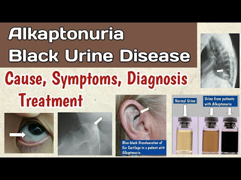 Alkaptonuria Black Urine Disease Cause, Symptoms, Inheritance ...