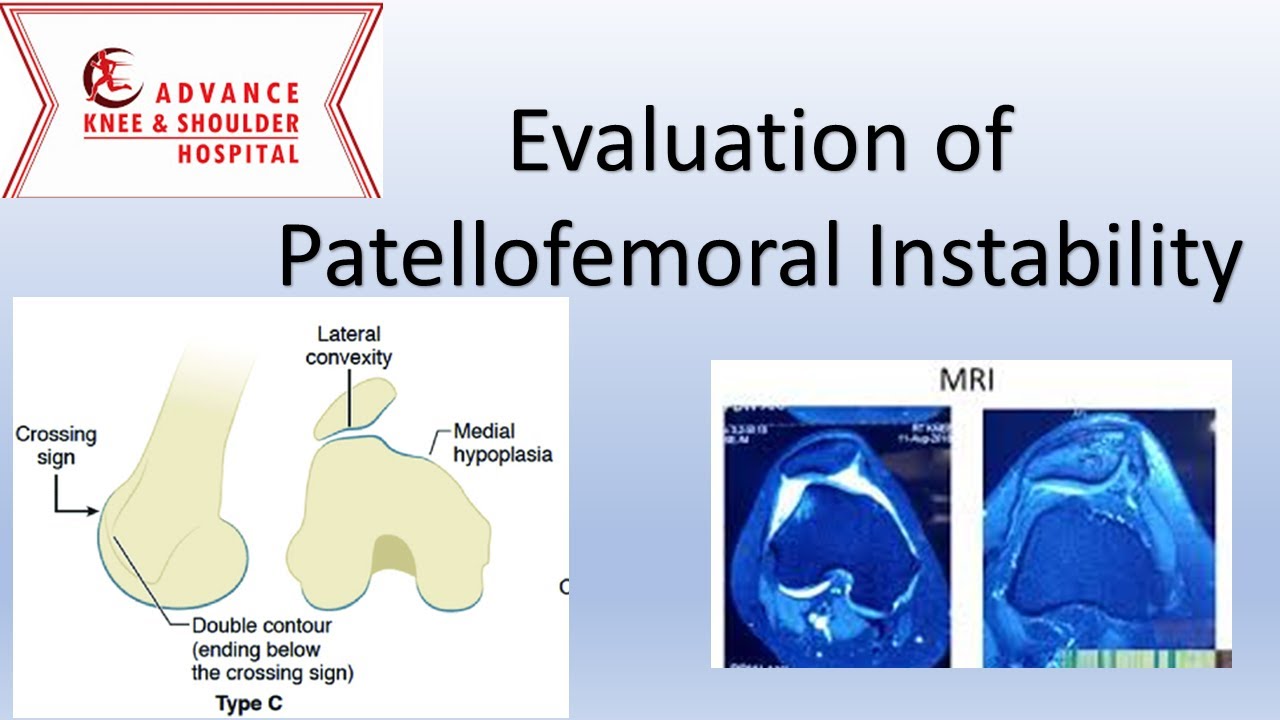 Evaluation of Patellofemoral Instability (Orthopedic Surgeons) - YouTube
