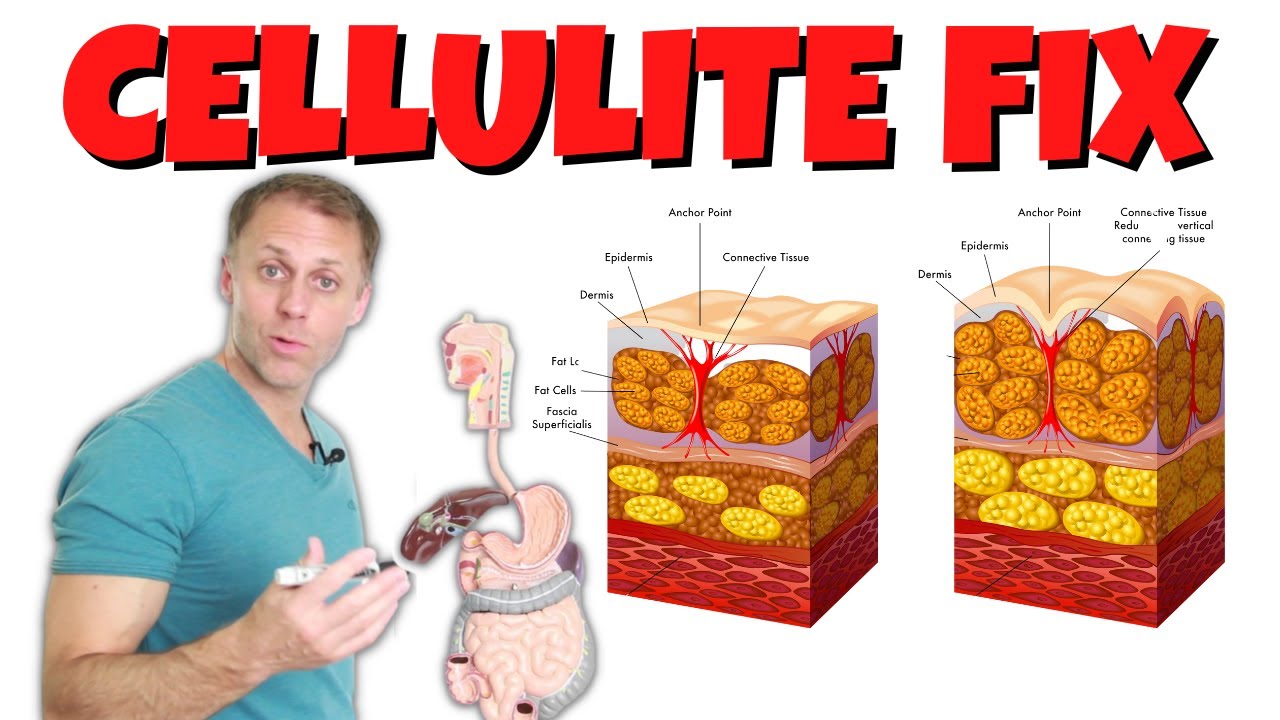 Understanding Cellulite and How to Fix It - YouTube