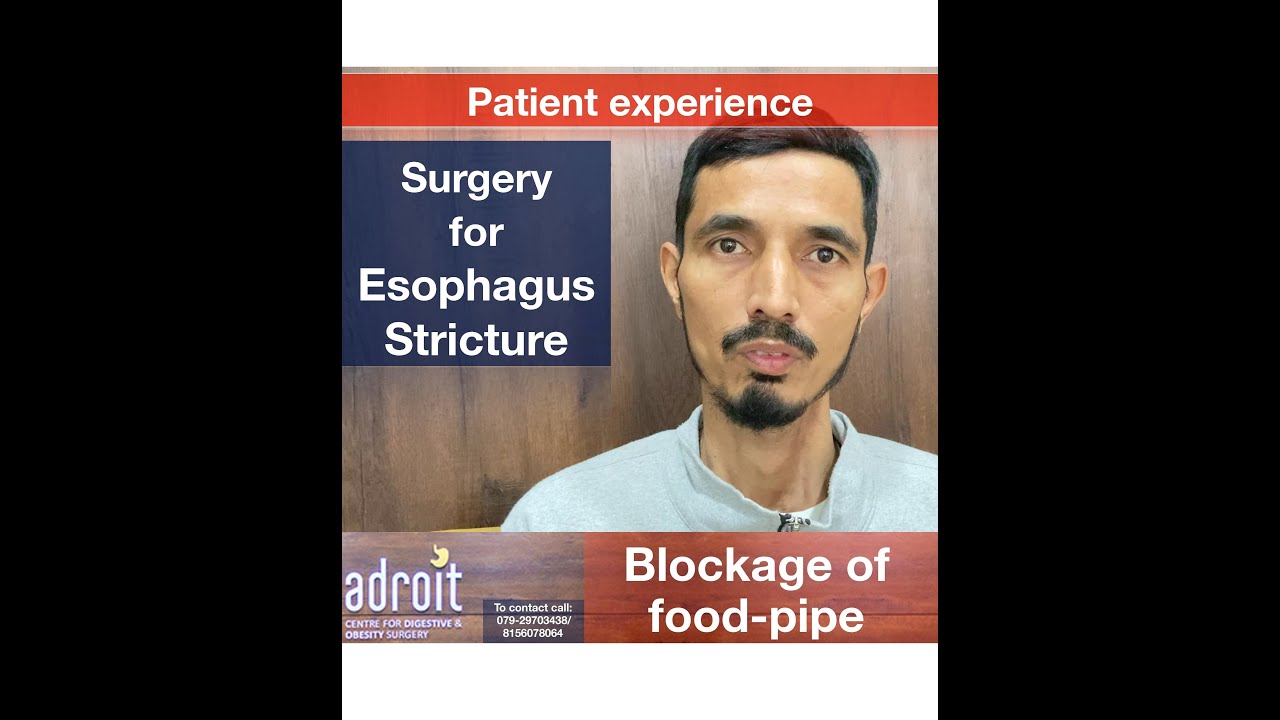 Surgery for esophagus stricture (Blockage of food pipe): Patient ...