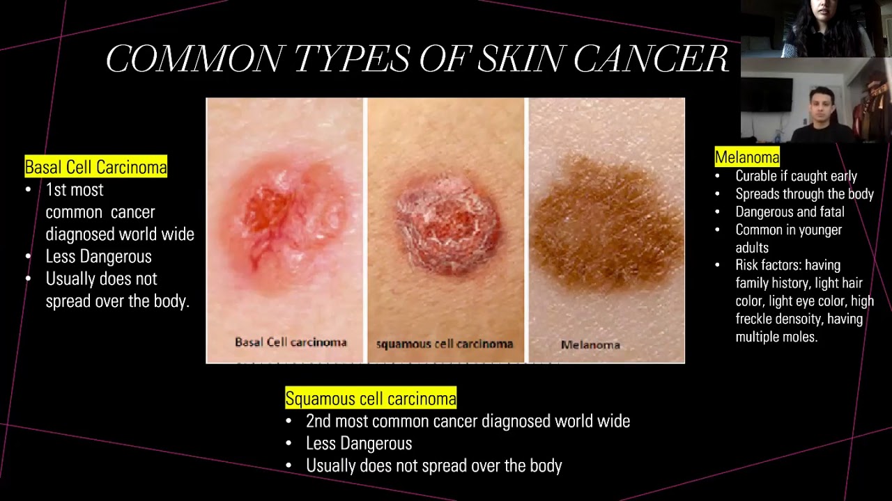 Skin Cancer Presentation - YouTube