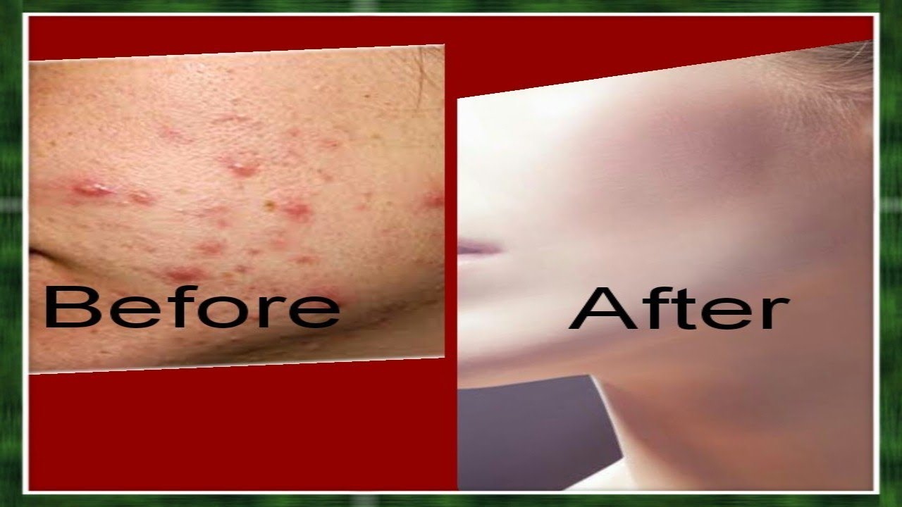 1 ही हफ्ते में पुराने जिद्दी pimples और darkspot को हटाए/Try these ...