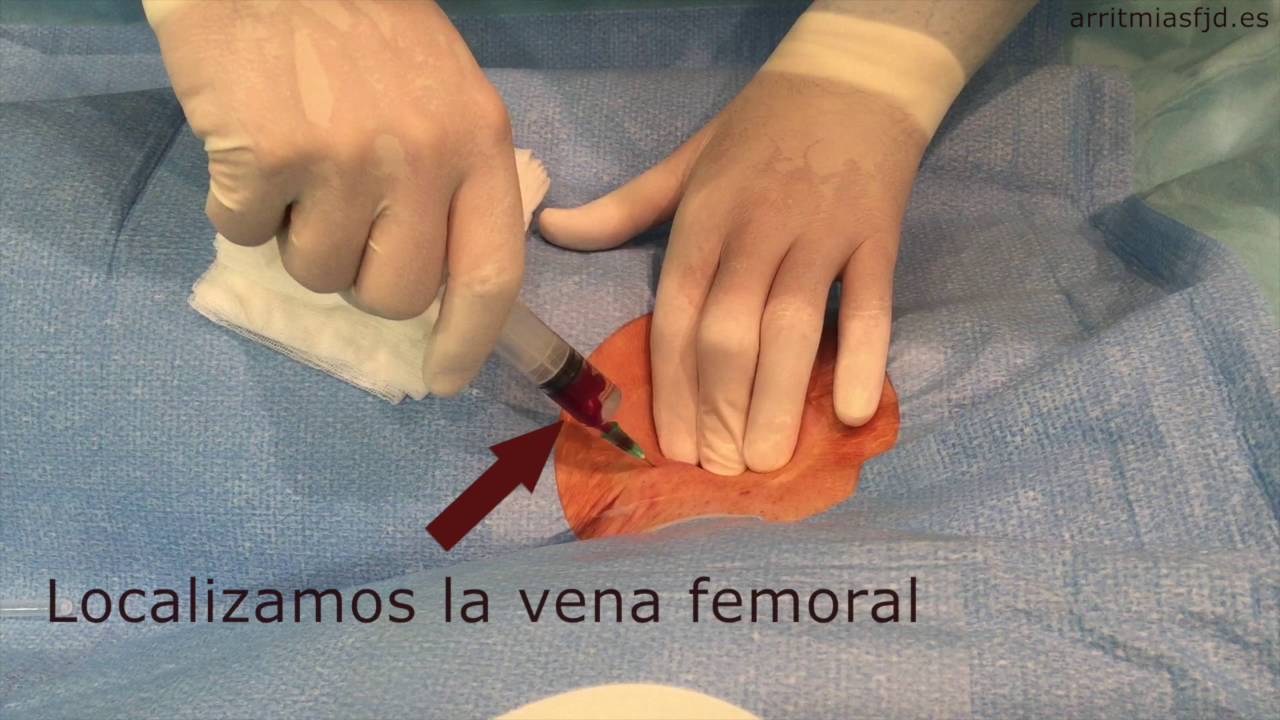 Técnica de punción femoral venosa - YouTube