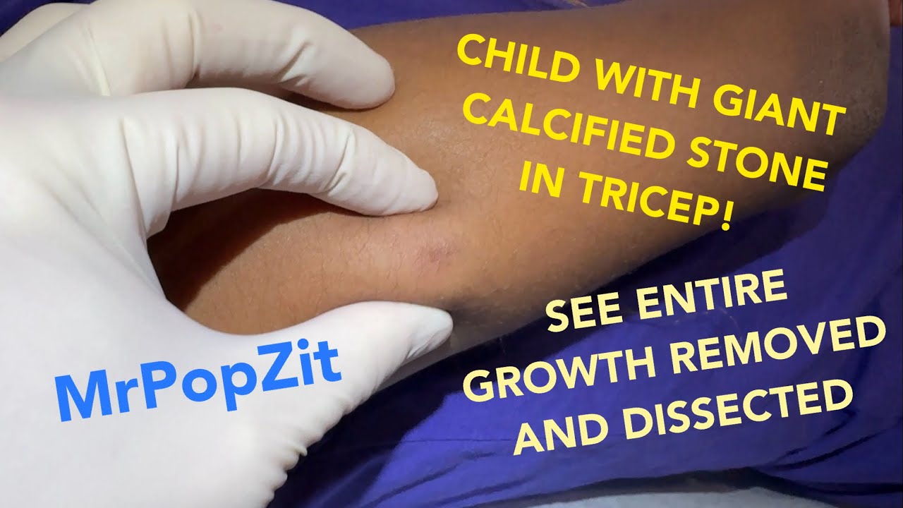 Lumpy rock hard meteorite stone growth DEEP in tricep of child.Must see ...