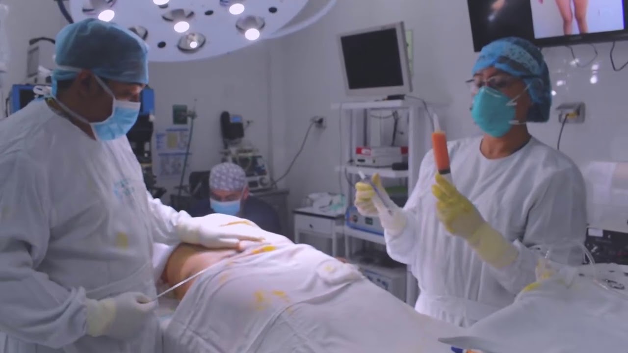 Cirugía de Lipo de abdomen - Dr César Calderón Cirujano Plástico - YouTube