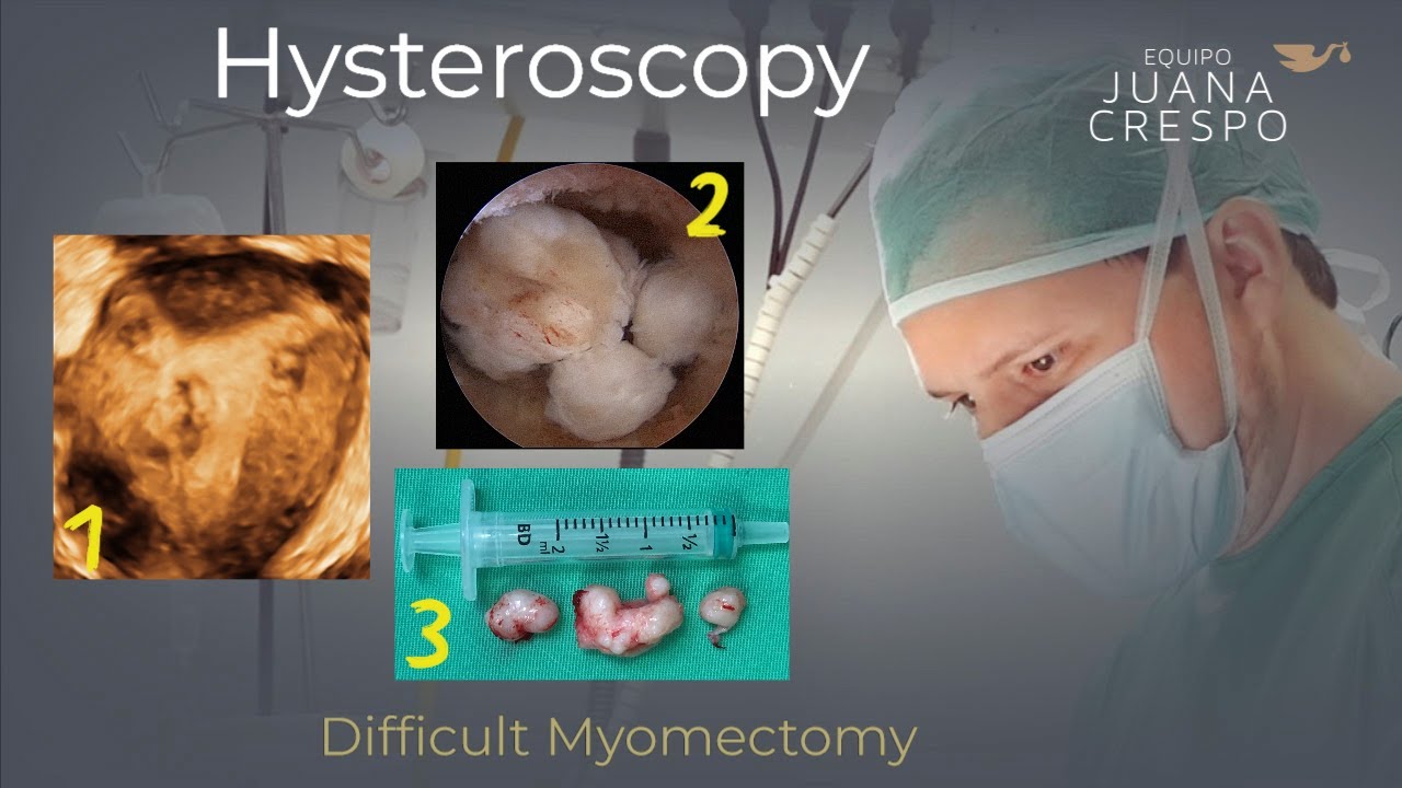 Incomplete Resectoscopic Myomectomy (Difficult case) - YouTube