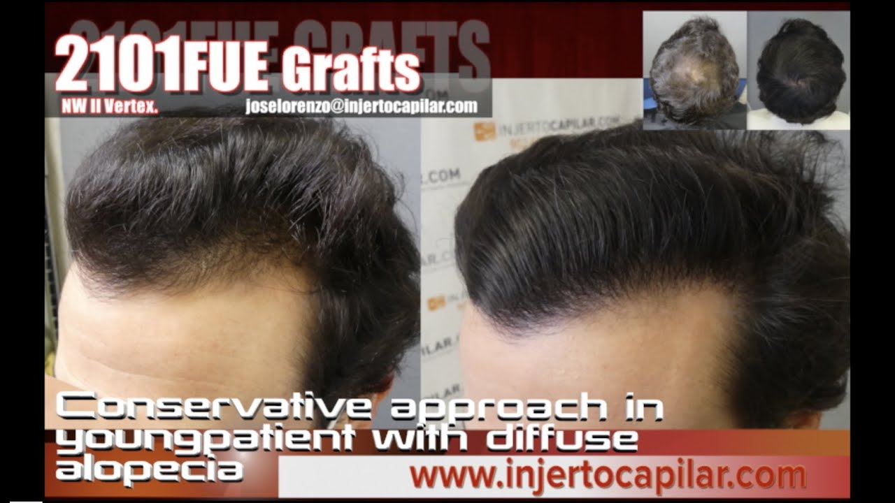 2101FUE Grafts. NW IIvertex. Conservative approach in young patient ...