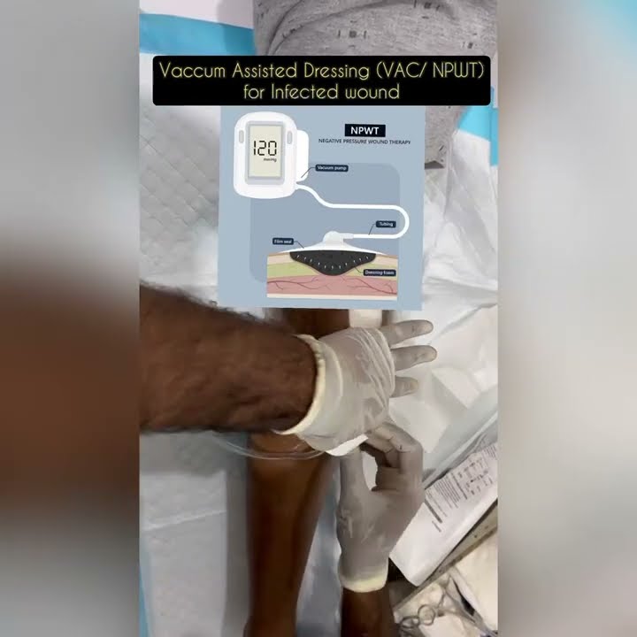 VAC dressing - YouTube
