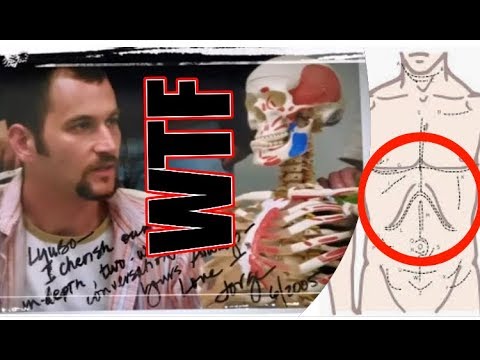 Medical Miracle - Al’s "Liver Delivery" and "Mercedes Scar" - YouTube