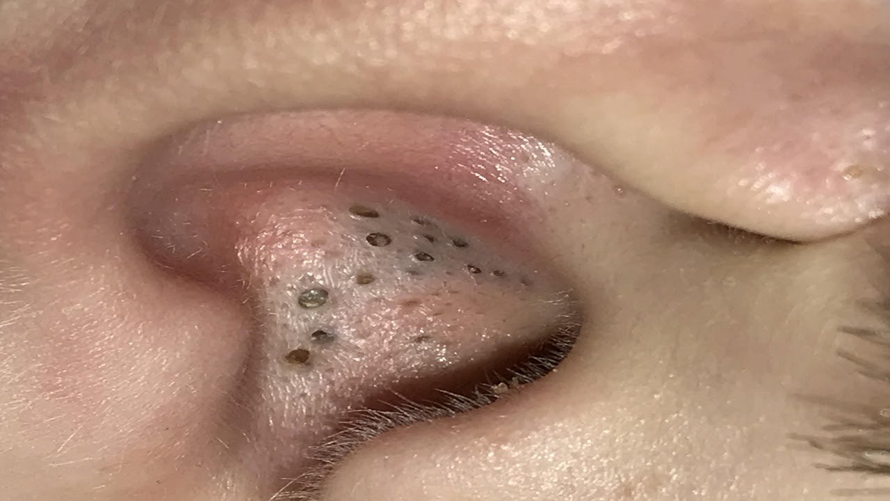 how to get rid of blackheads in your ear naturally and easy - YouTube