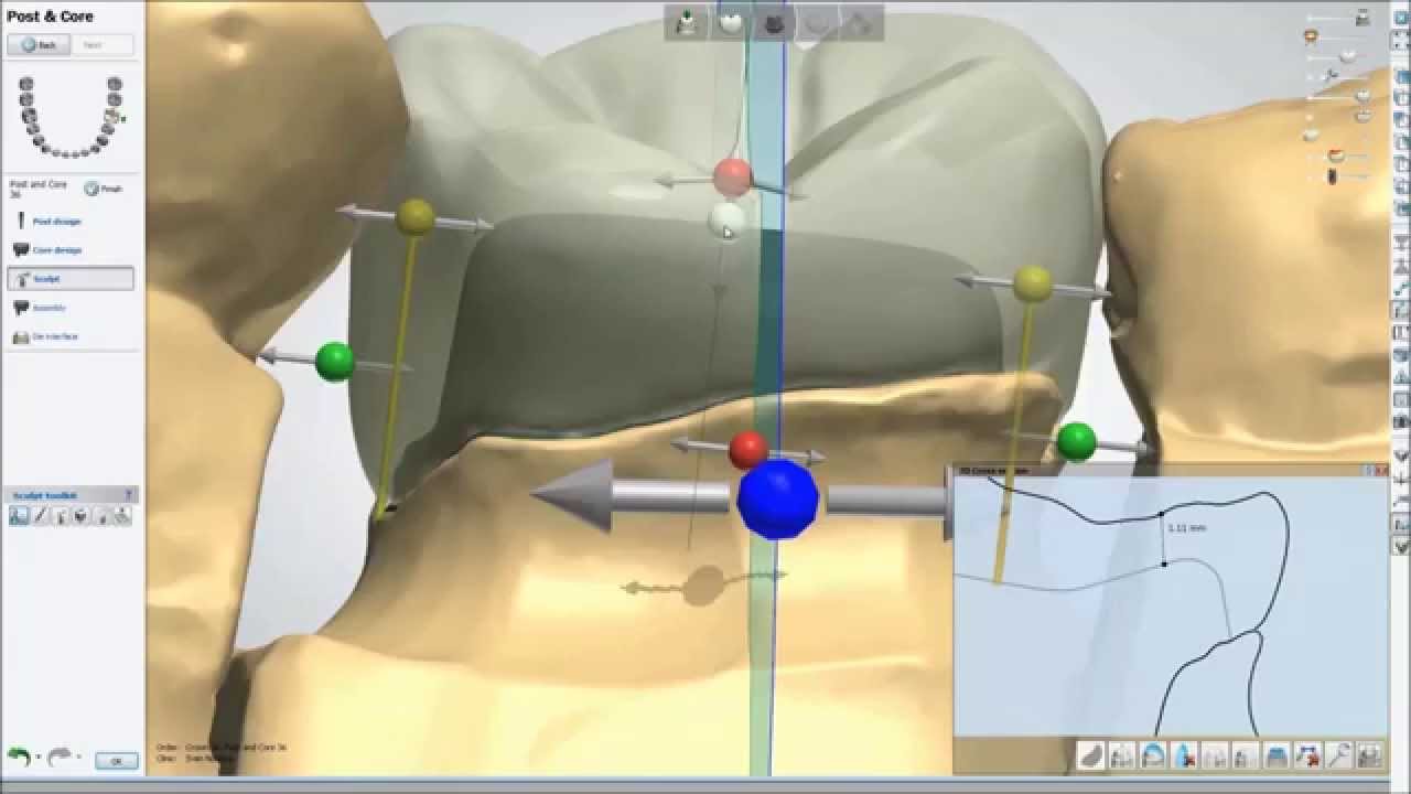 Dental System™ 2013 – Inlay-Core - YouTube