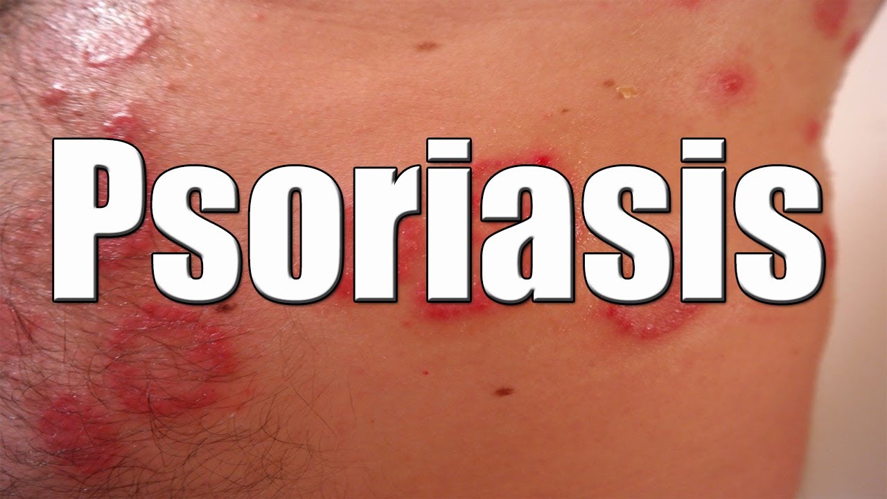 Psoriasis and Penis Care: What Men Must Know - YouTube