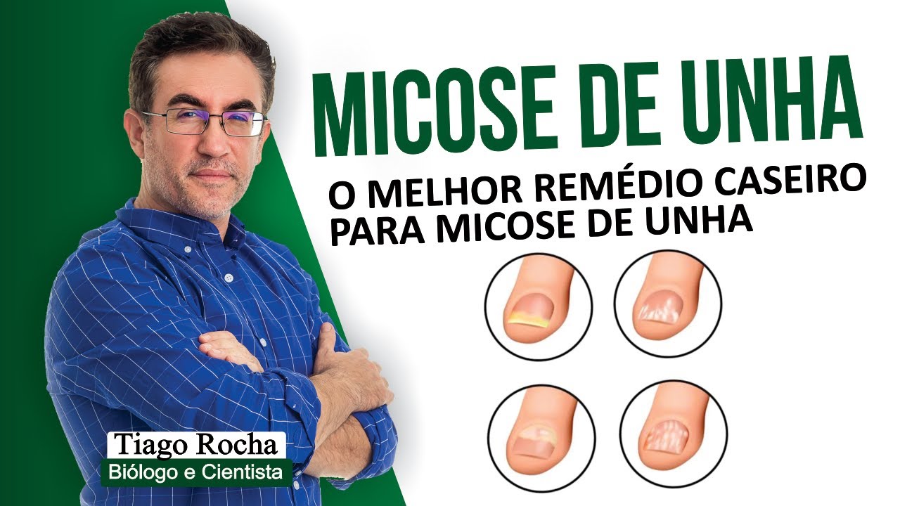O melhor REMÉDIO CASEIRO para MICOSE DE UNHA. - YouTube