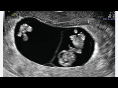 OBSTETRICS SCANS IN FIRST TRIMESTER : MSD | CRL | FL . - YouTube