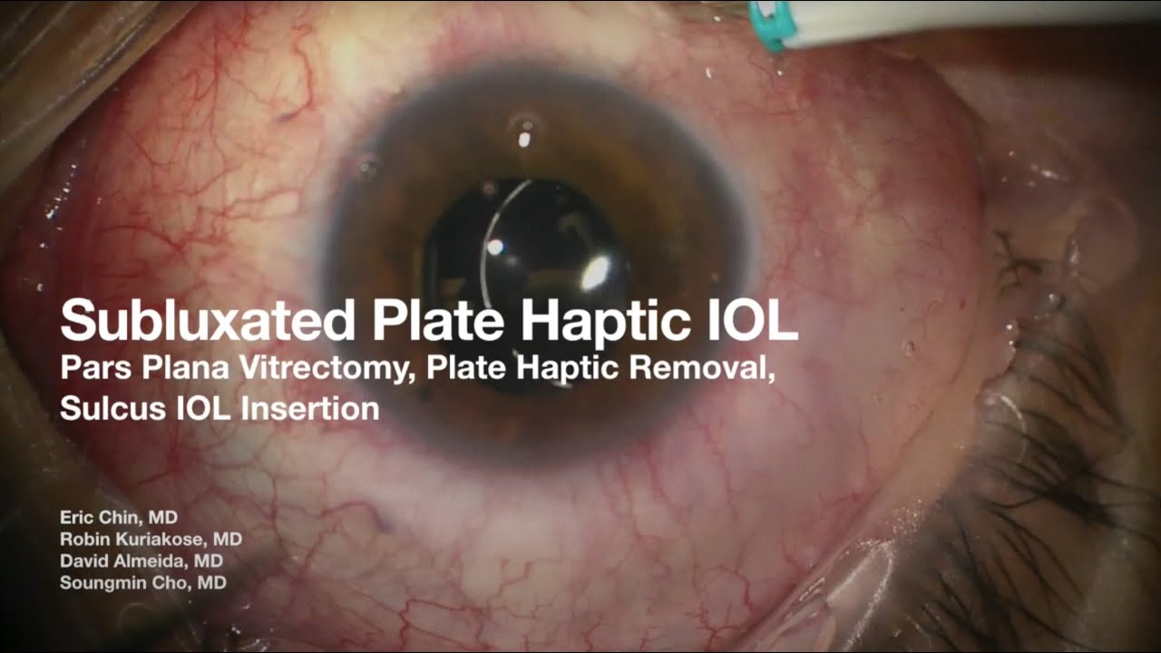 Subluxated Plate Haptic IOL Removal and Sulcus IOL Insertion - YouTube