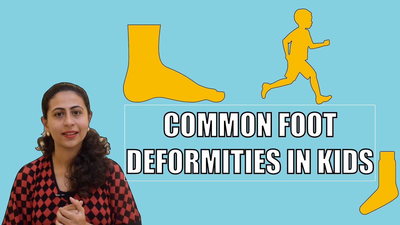 COMMON FOOT DEFORMITIES IN KIDS - YouTube