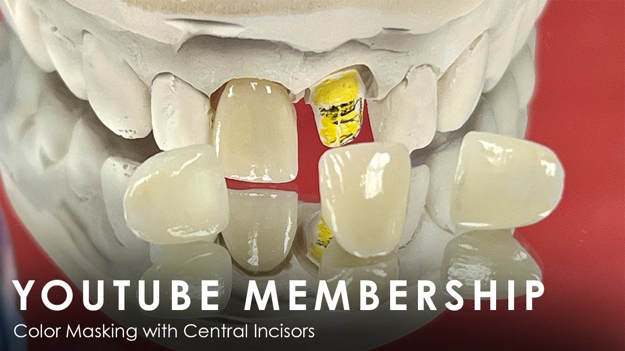 Color Masking with Central Incisors - YouTube