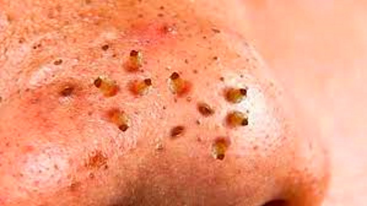 Amazing Large Blackheads Extraction BIG Cystic Acne Blackheads ...