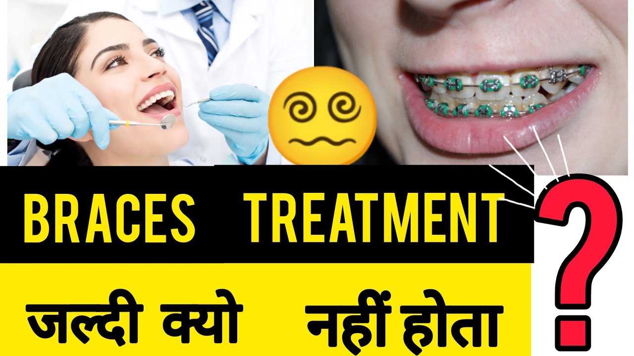 || braces treatment जल्दी क्यों नहीं होता || braces treatment process ...