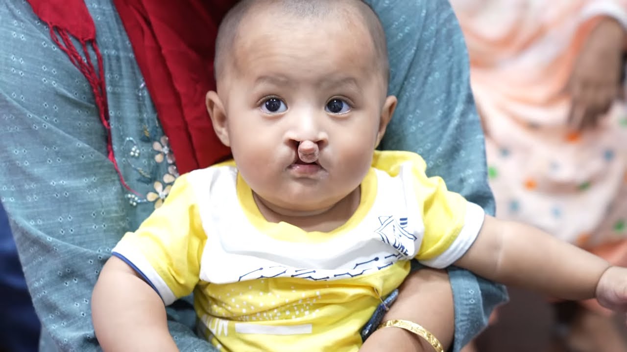 Rare Bilateral Cleft Baby from Bangladesh - Before Surgery Consultation ...