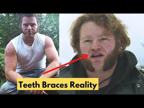 How Does Gabe From Alaskan Bush People Have Braces