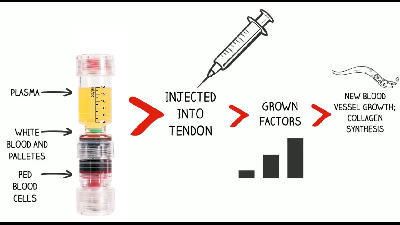 TriCell TriPReP® Tubex® PRP - Chronic Pain Patient Centric TriCell Bio ...