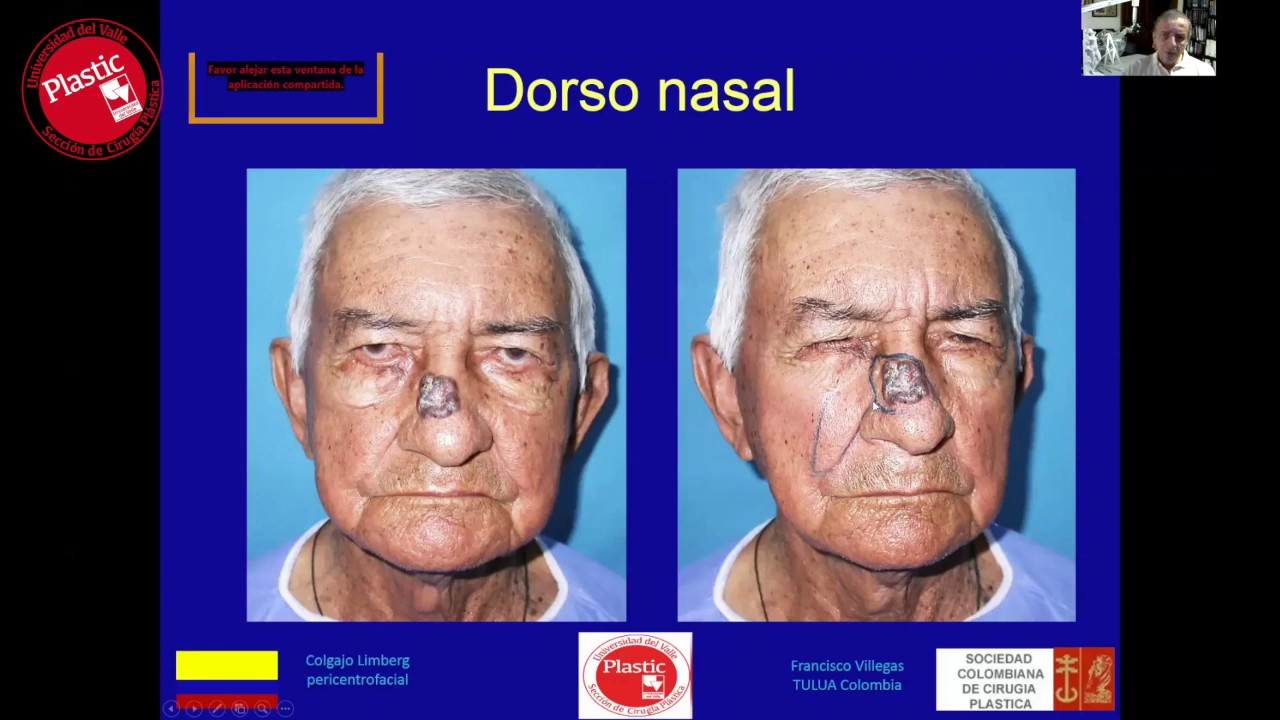 PLASTICUV - Colgajos Romboidales - YouTube