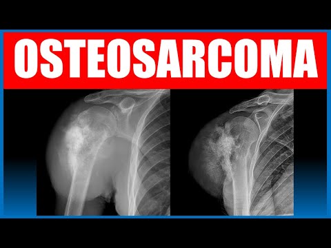 Osteosarcoma #radiology #xray #doctor #bonecancer - YouTube