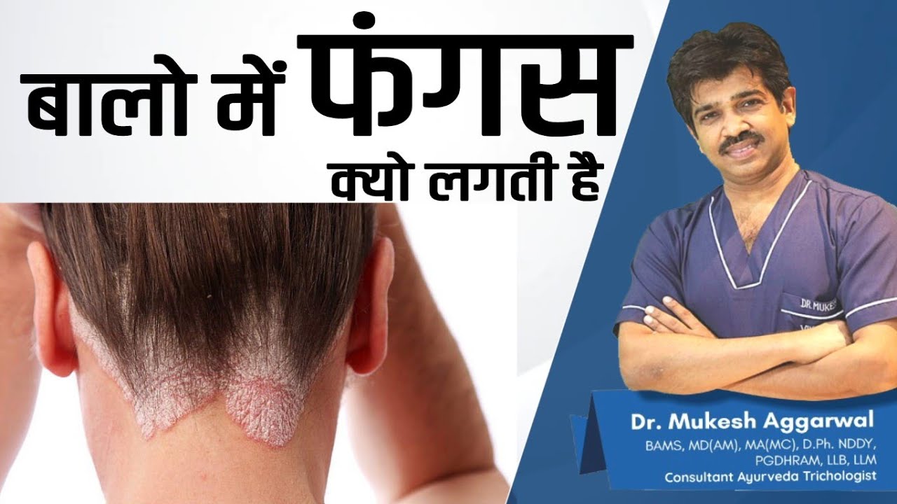 Cause & Treatment of Fungal Infection in Hair | Dr Mukesh Aggarwal ...