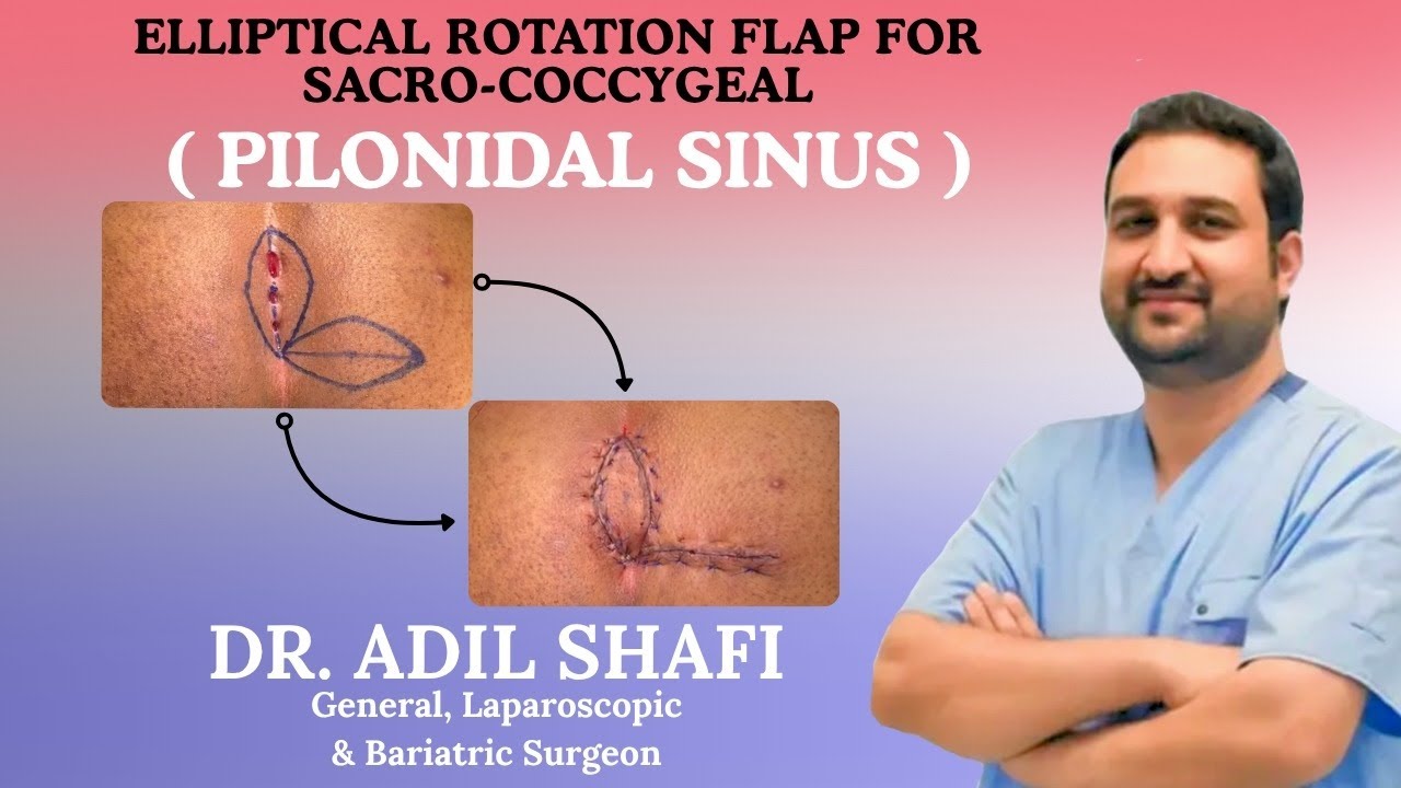 ELLIPTICAL ROTATION FLAP FOR SACRO-COCCYGEAL ( PILONIDAL SINUS ) - YouTube