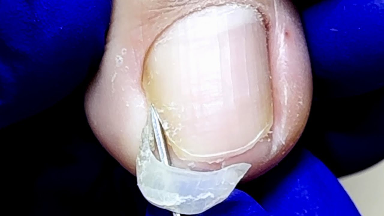Cut off the long and thin ingrown nails and correct them[Doctor Liu ...