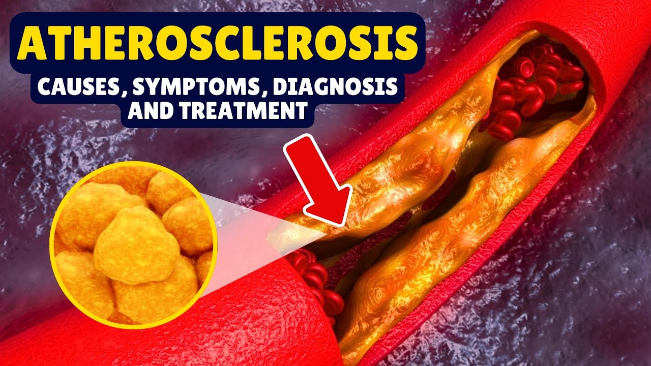 What is Atherosclerosis? Causes, Signs and Symptoms, Diagnosis ...