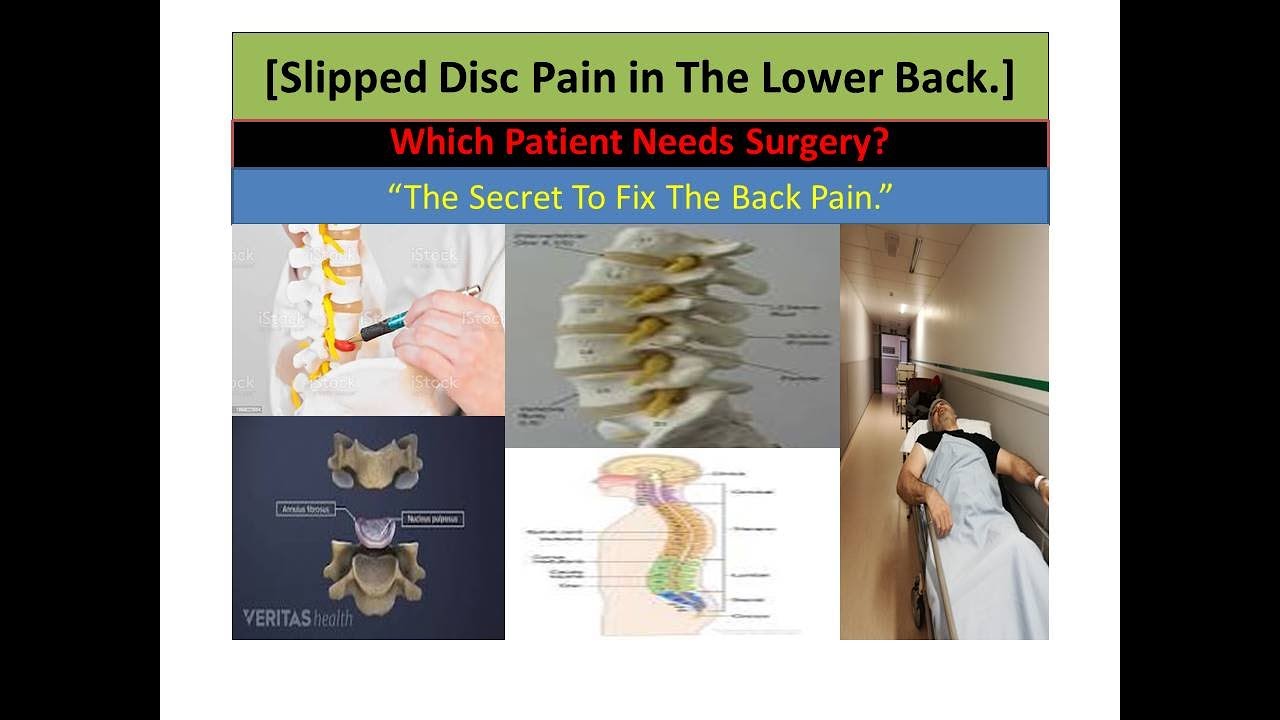 Herniated Slipped Disc "L4 & L5". [Treatment & Secret] (Fix Disc with ...